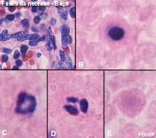 Estudando patologia: Fases da Necrose